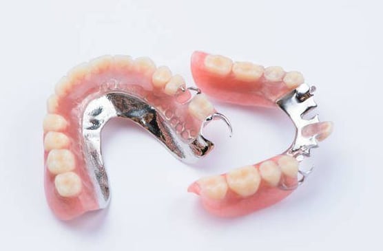 Fitting Crowns Under an Existing Partial Denture