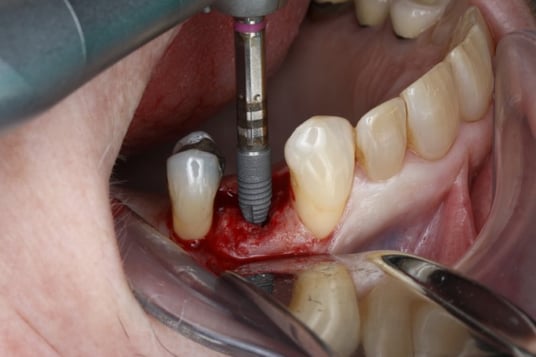 Navigating Precision: Guided vs. Freehand Dental Implants