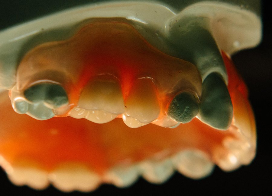Denture and Partials - Pittman Dental Laboratory